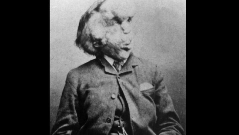 What’s a Rare Disease? Here are 6 Strange Diseases You’ve never Heard ...