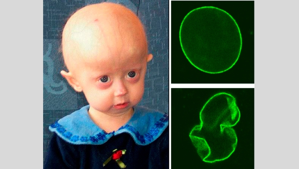 What’s a Rare Disease? Here are 6 Strange Diseases You’ve never Heard ...