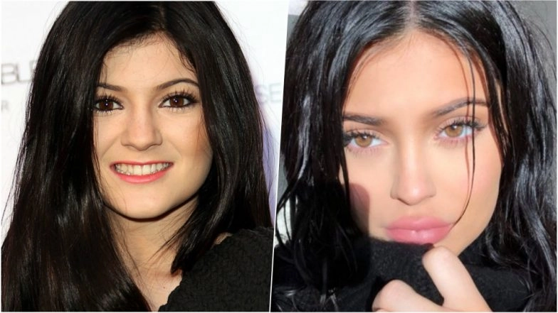 Lip Fillers: 6 Things You Should Know About Before and After Tricks of ...