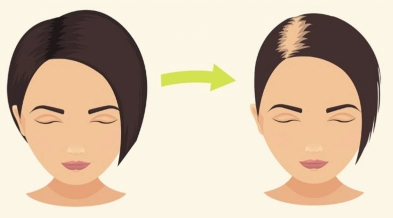 Hair Loss Causes: Is Your Hair Fall Normal? How Much Shedding Is OK and ...