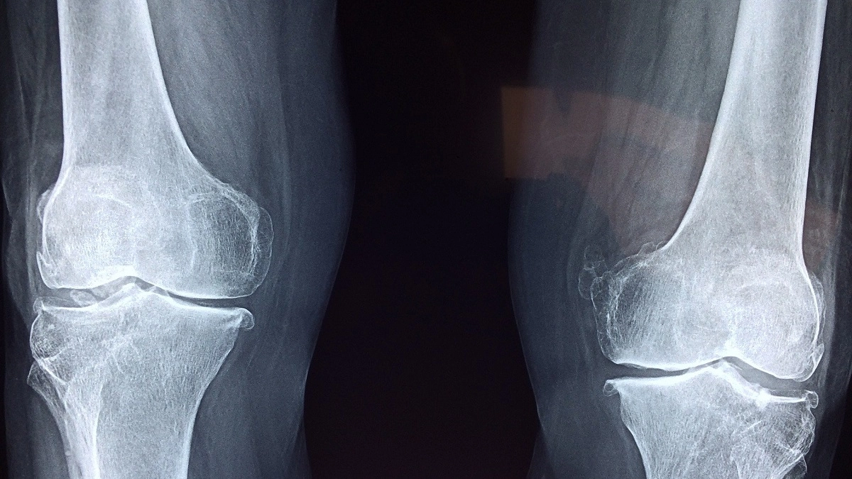 Health & Wellness News | What Is Bone Death? From Symptoms to Causes ...