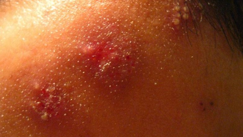 Chickenpox Outbreak in Uttar Pradesh's Ballia, 20 School Kids, One ...