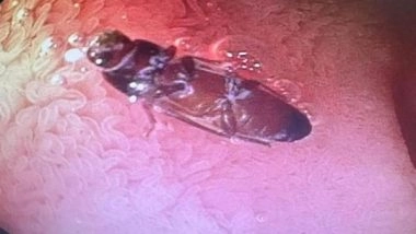 India News | Delhi Doctors Save Man's Life by Removing Live Cockroach ...